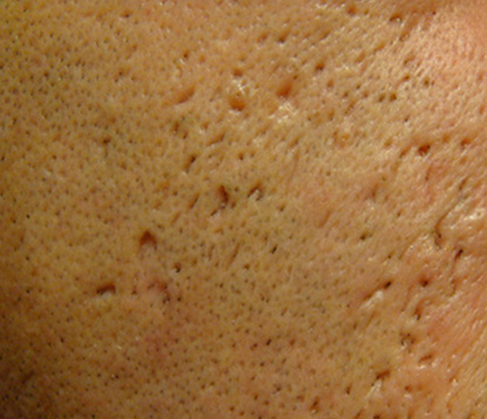 content Advance Pitting Scar - Peerada-Clinic